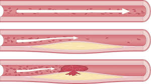 Atherosclerosis In Chickens – Bitchin' Chickens